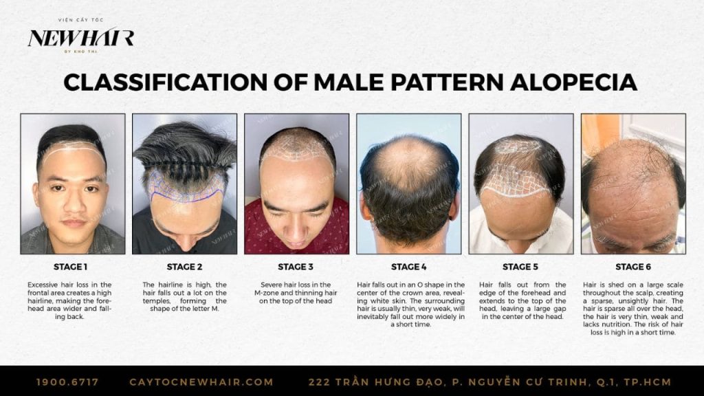 What Is Natural Hair Transplant? What You Need to Know about It!