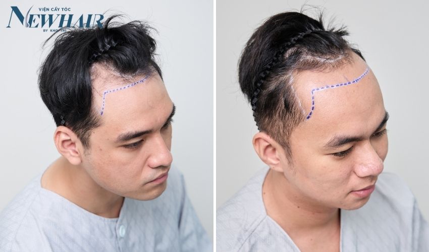 Những Dấu Hiệu Mọc Tóc Lại Và Nhận Biết Còn Nang Tóc