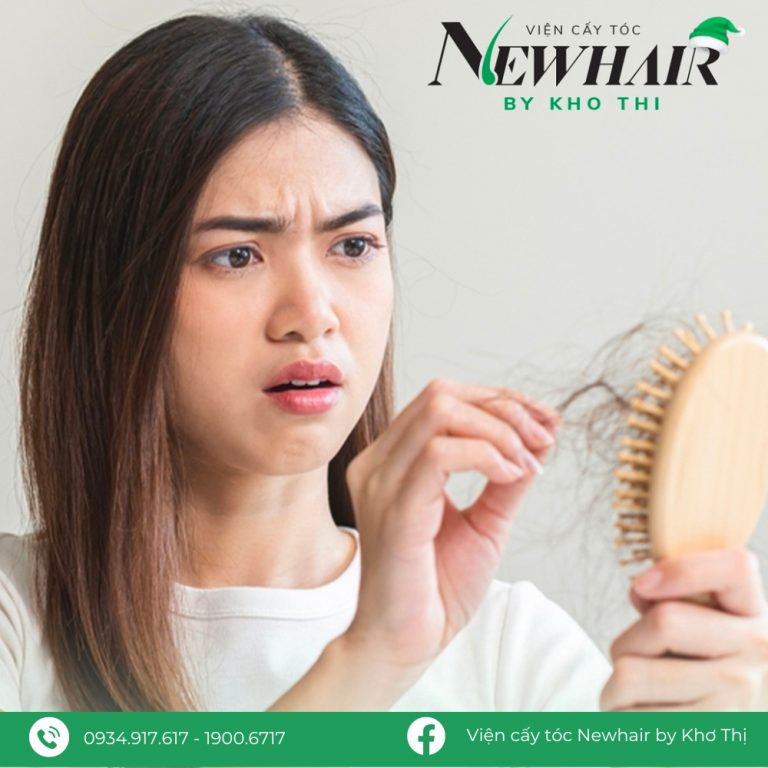 [Cập nhật 2024] Giá cấy tóc cho người trán cao? Nơi cấy uy tín