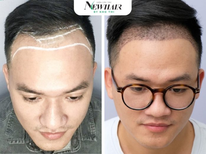 Nang tóc là gì, ảnh hưởng như thế nào khi cấy tóc?