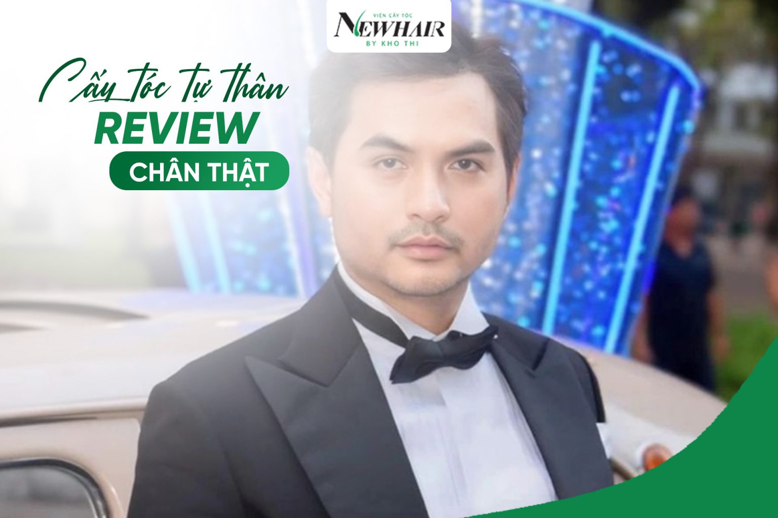 Review chân thật từ khách hàng đã điều trị cấy tóc tại NewHair.