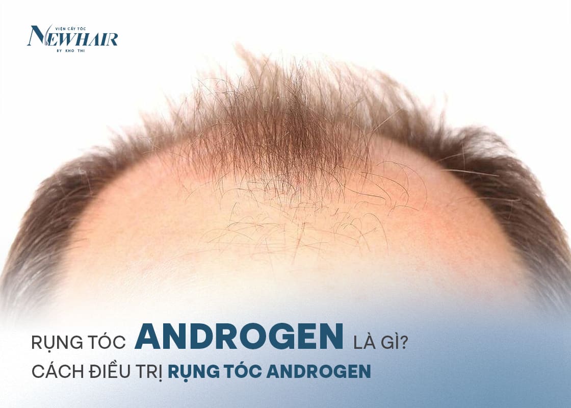 Rụng Tóc Androgen Là Gì? Cách Điều Trị Rụng Tóc Androgen